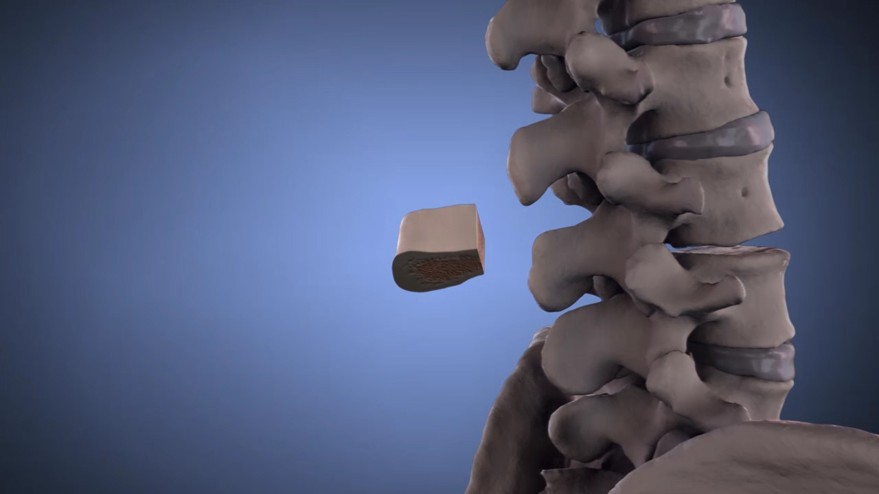 Medical Animation from Visual Health Solutions